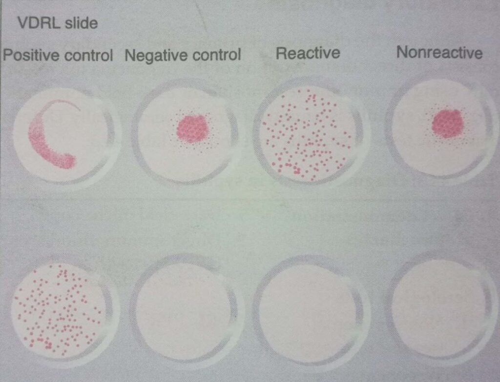 Treponema Pallidum: Morphology, Syphilis, Lab Diagnosis | NotesMed
