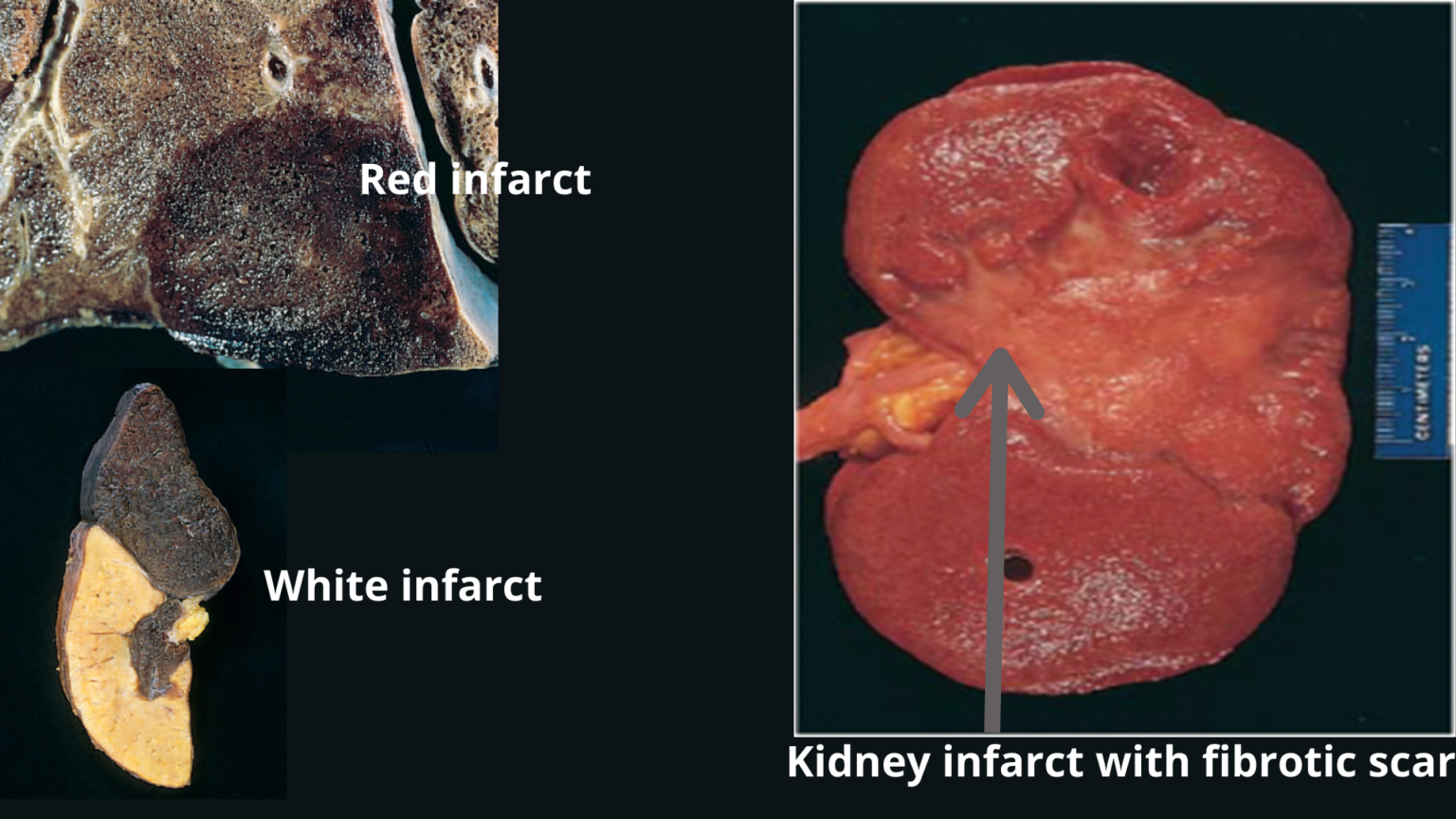 Infarction: Types, Pathogenesis, Morphology - NotesMed | NotesMed