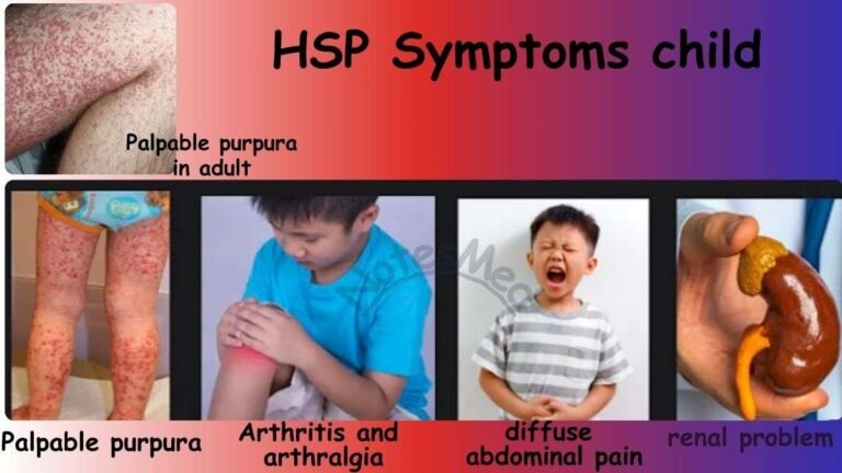 Henoch-Schönlein Purpura Symptoms: Comprehensive Guide